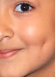 Dimple creation surgery in jaipur - Kalpana Aesthetics