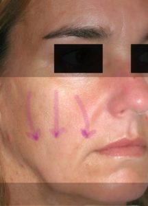 Fillers/Botox Surgery in Jaipur - Kalpana Aesthetics